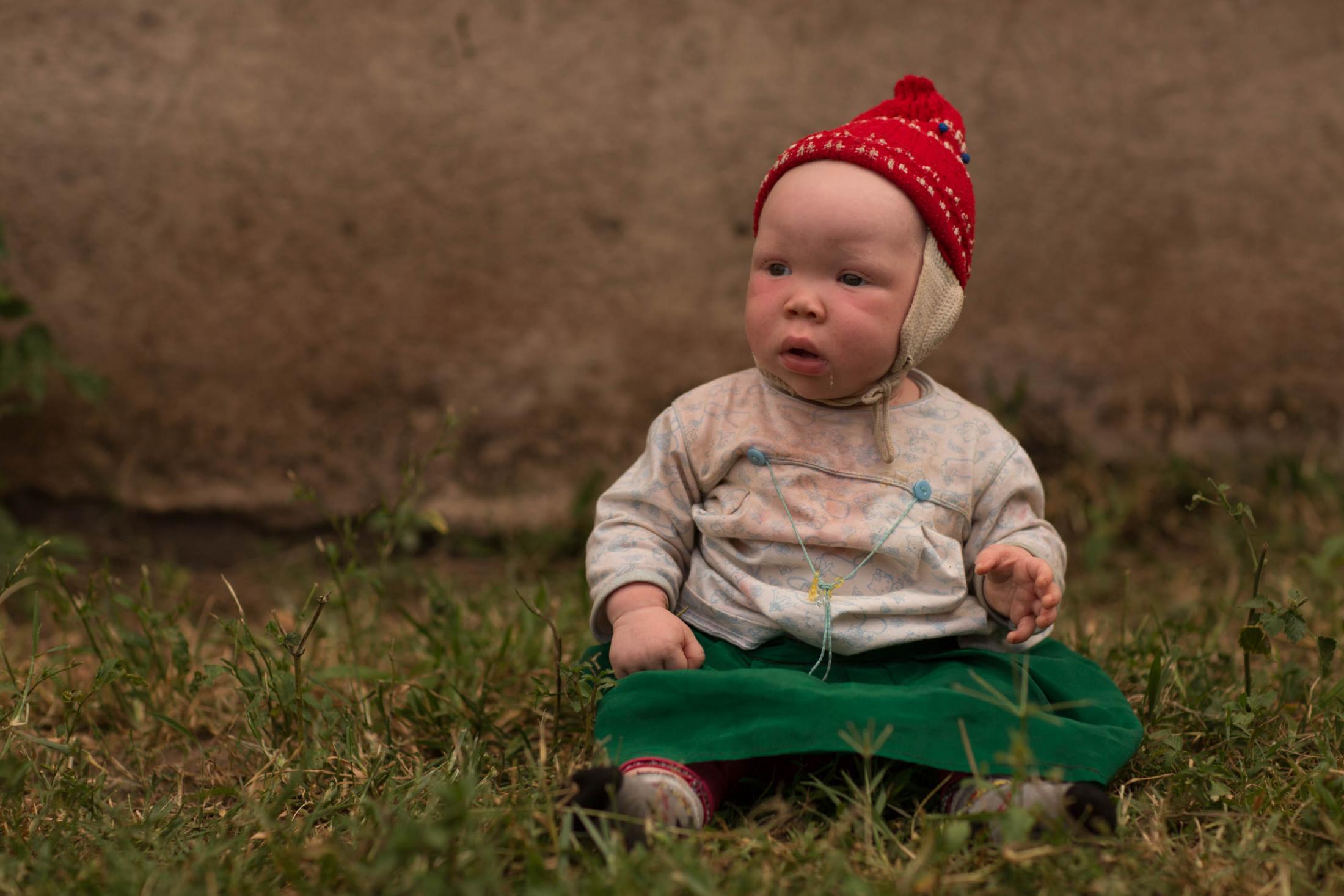 Rotary helps Tanzanians with albinism | Rotary International